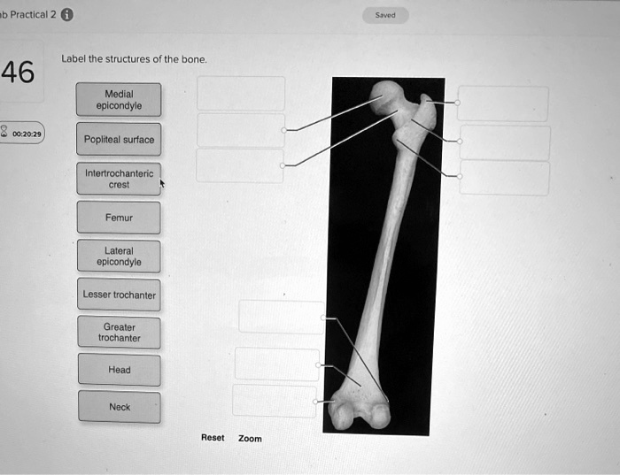 Label the structures of the bone. Medial epicondyle Popliteal surface ...