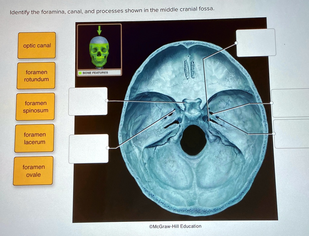 Identify the foramina, canal, and processes shown in the middle cranial fossa. optic canal ...