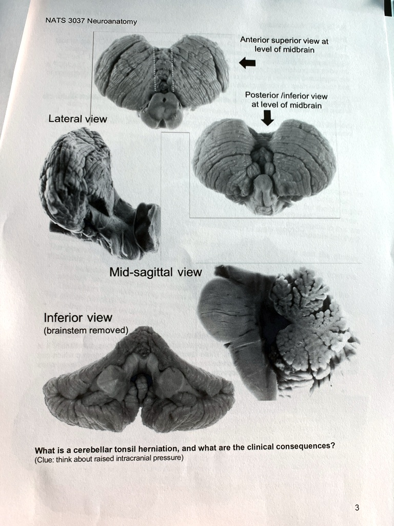 nats 3037 neuroanatomy anterior superior view at level of midbrain ...