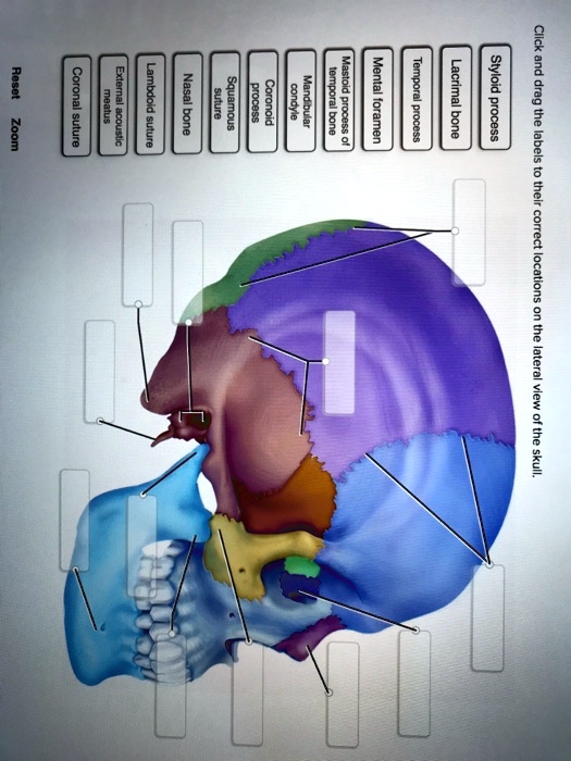 SOLVED: Reset Zoom Coronal suture External acoustic meatus Lambdoid ...