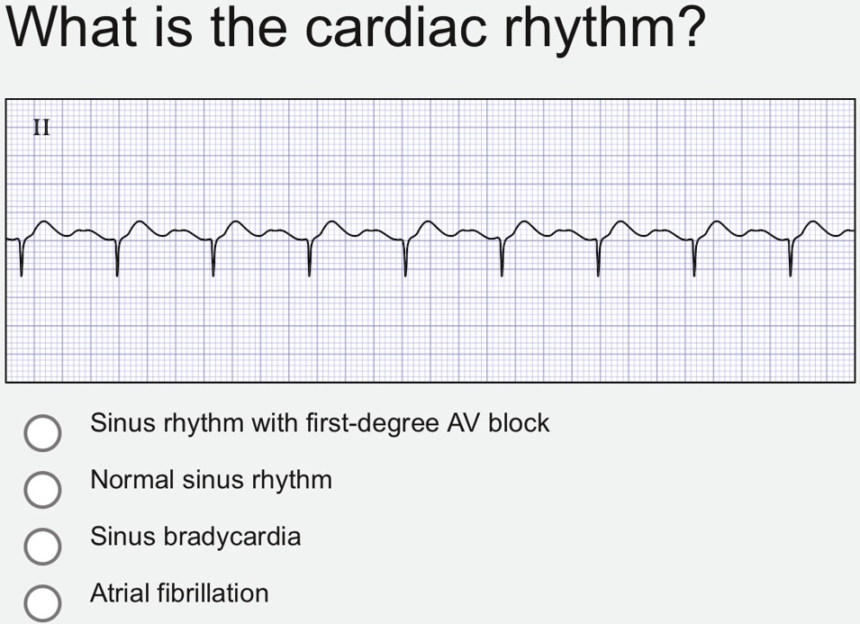 What is the cardiac rhythm shown in the EKG strip below? Choose from ...