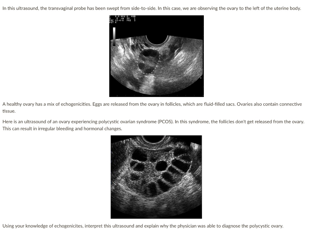 SOLVED: In this ultrasound, the transvaginal probe has been swept from ...