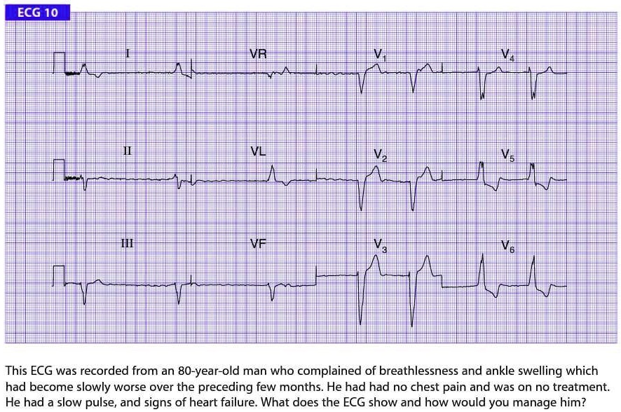SOLVED: This ECG was recorded from an 80-year-old man who complained of ...