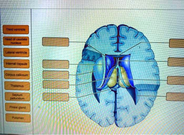 SOLVED: Third ventricle Head of caudate nucleus Lateral ventricle ...