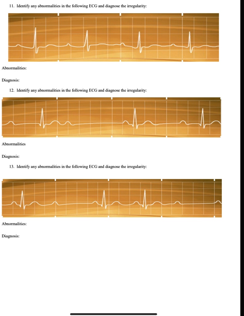 SOLVED: Identify any abnormalities in the following ECG and diagnose the irregularity ...