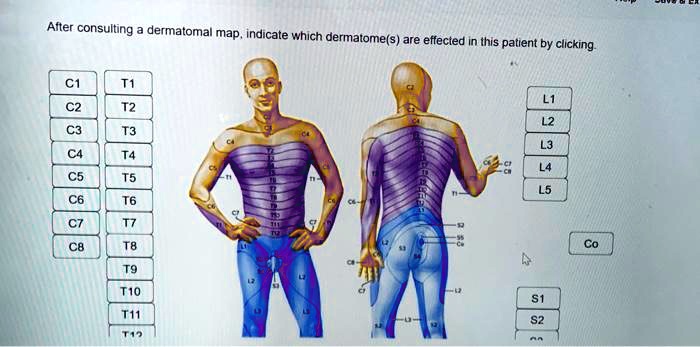 SOLVED: After consulting dermatoma map, indicate which dermatome(s) are ...