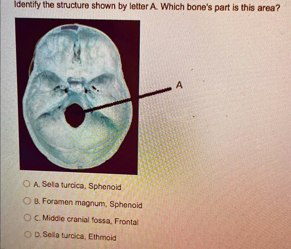 Identify the structure shown by letter A. Which bone's part is this ...