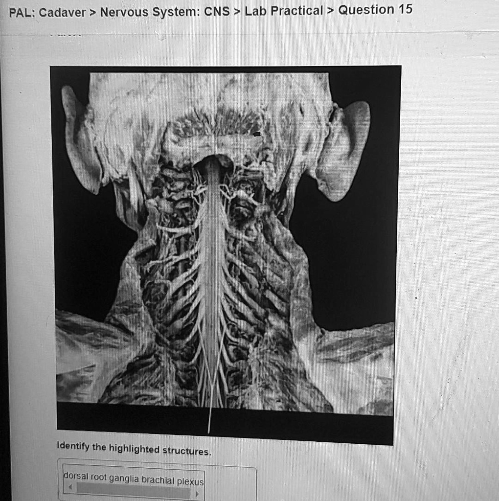 SOLVED: PAL Cadaver > Nervous System CNS Lab Practical Question 15 Identify the highlighted ...