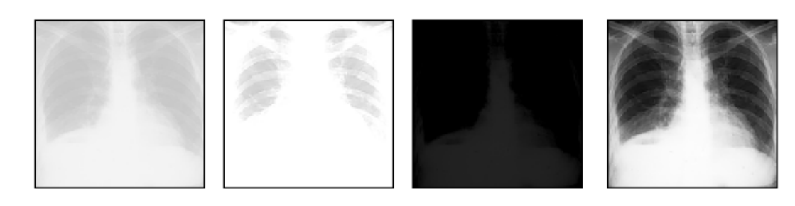 SOLVED: 12.How does a planar chest X-ray image chest (radiograph) look ...