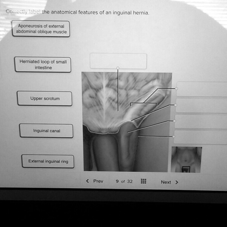 Correctly label the anatomical features of an inguinal hernia ...