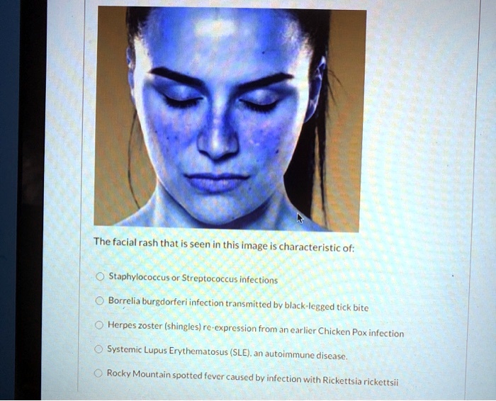 the facial rash that is seen in this image is characteristic of ...