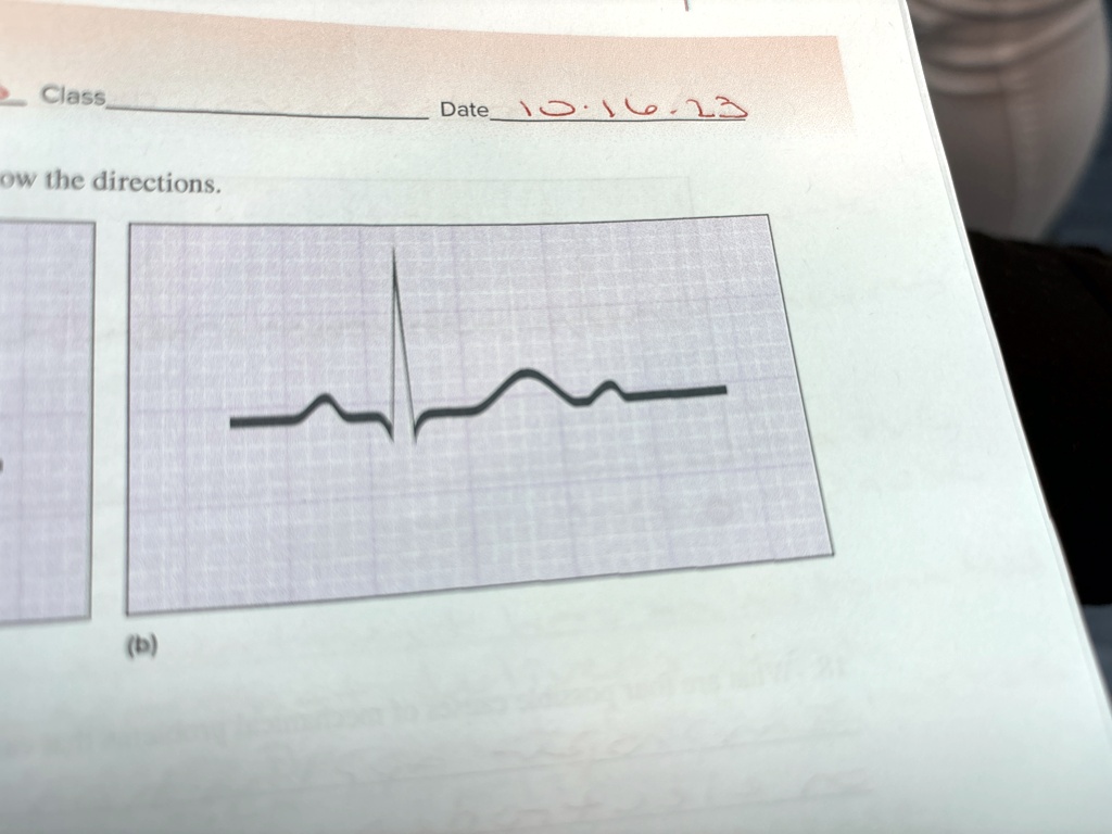on part b draw lines and label the tracing to show when atrial ...
