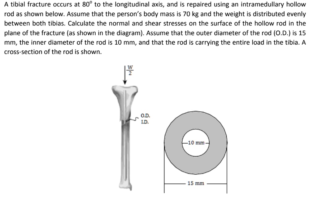 A tibial fracture occurs at 80° to the longitudinal axis, and is ...