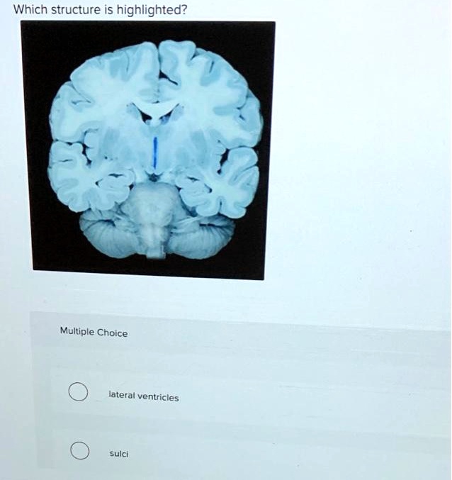 SOLVED: Which structure is highlighted? Multiple Choice lateral ventricles sulci