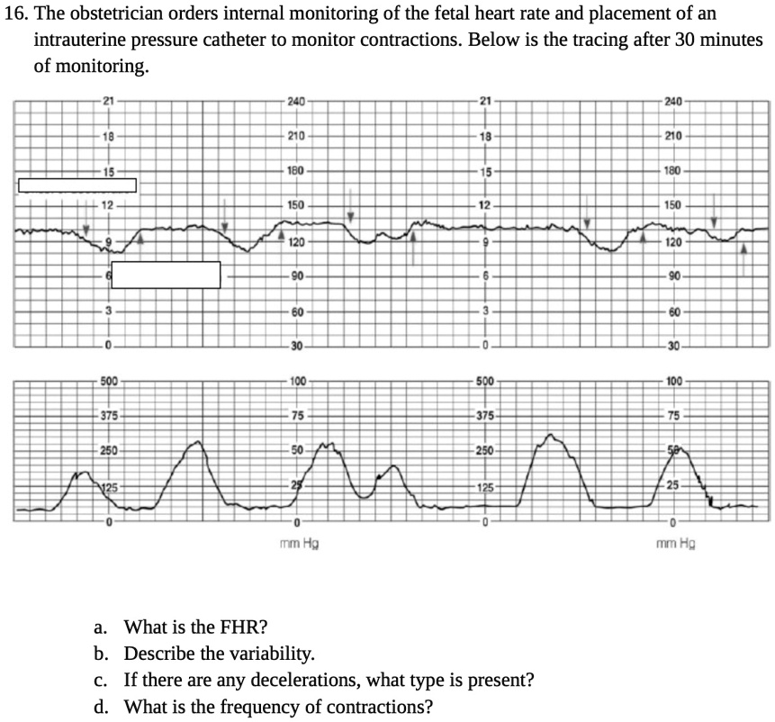 [GET ANSWER] 16 the obstetrician orders internal monitoring of the ...