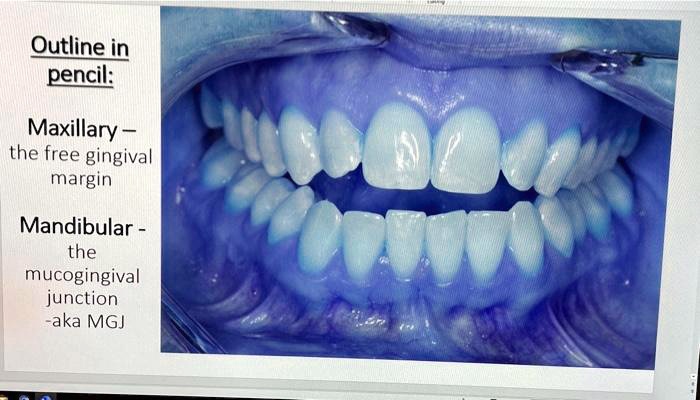 SOLVED: Maxillary - the free gingival margin Mandibular - the ...