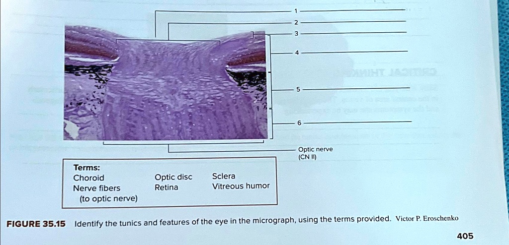 2 3 4 5 6 Optic nerve (CN II) Terms: Choroid Nerve fibers (to optic ...