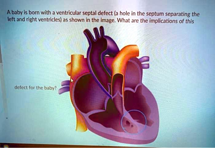 A baby is born with a ventricular septal defect (a hole in the septum ...