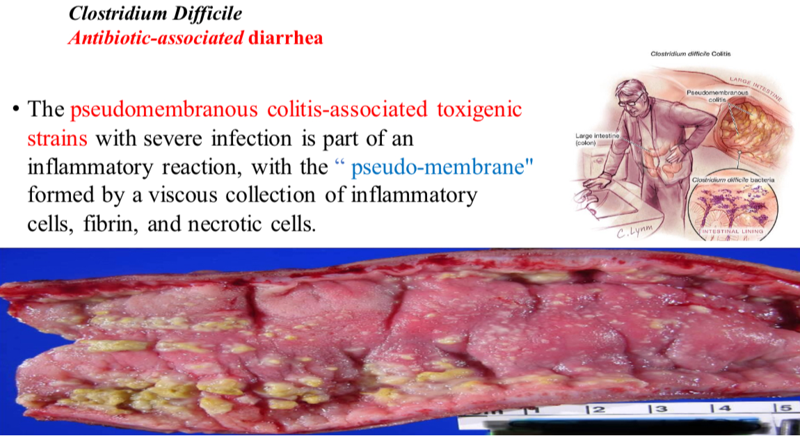Clostridium Difficile Antibiotic-associated diarrhea - The ...