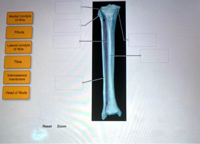 SOLVED: Medial condyle of tibia Fibula Lateral condyle of tibia Tibia ...