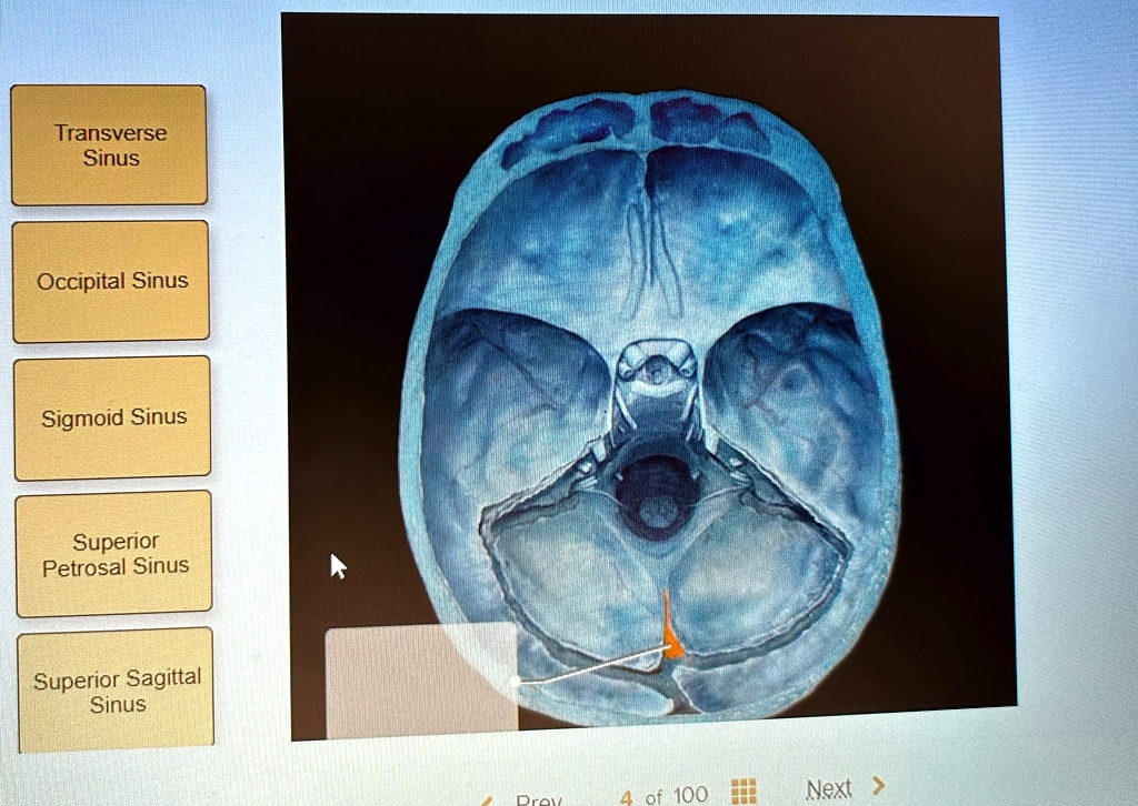 Transverse Sinus Occipital Sinus Sigmoid Sinus Superior Petrosal Sinus ...