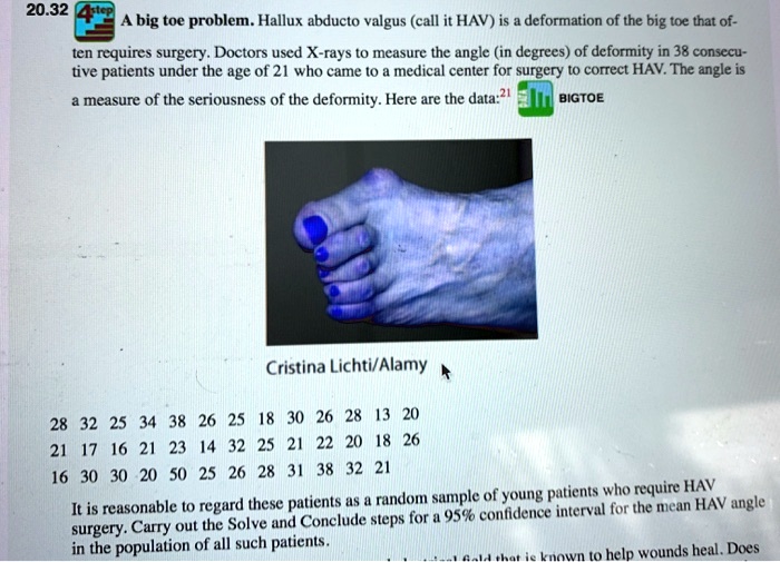 SOLVED:20.32 Abig toe problem. Hallux abducto valgus (call it HAV) is ...