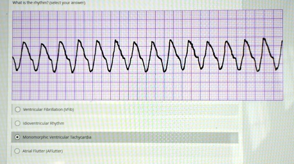 what is the rhythm select your answer ventricular fibrillation vfib ...