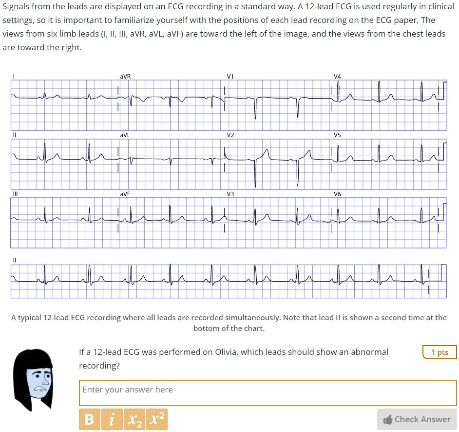 Signals from the leads are displayed on an ECG recording in a standard ...