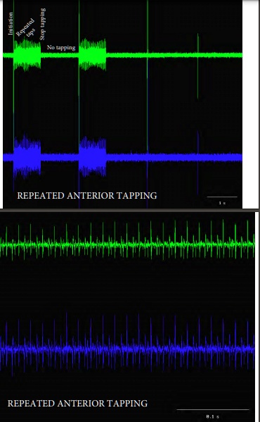 SOLVED: Japping REPEATED ANTERIOR TAPPING REPEATED ANTERIOR TAPPING