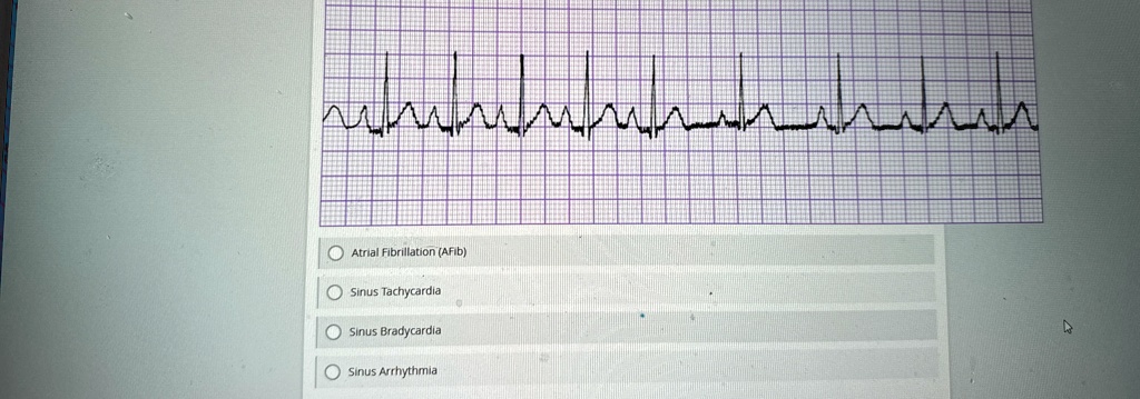 atrial fibrillation afib sinus tachycardia sinus bradycardia sinus ...
