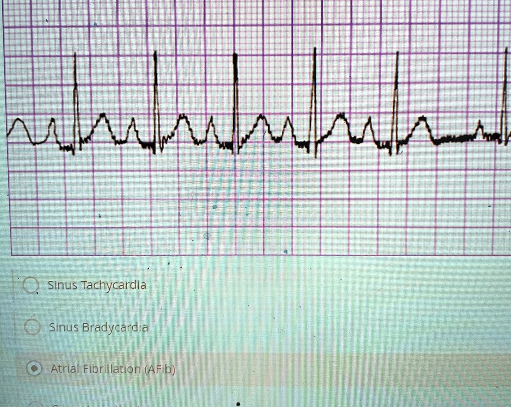 sinus tachycardia sinus bradycardia atrial fibrillation afib sinus ...
