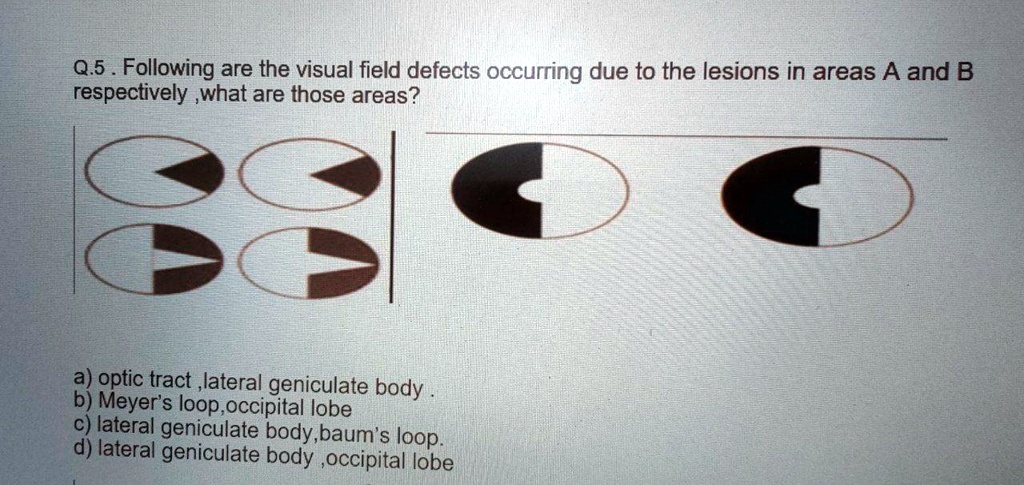 q5 following are the visual field defects occurring due to the lesions ...