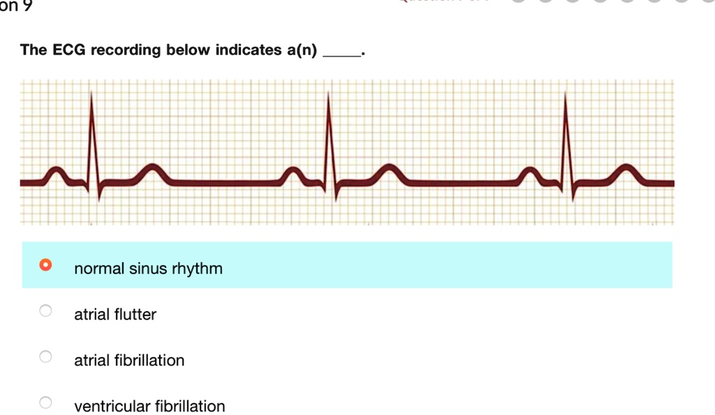 the ecg recording below indicates an normal sinus rhythm atrial flutter ...