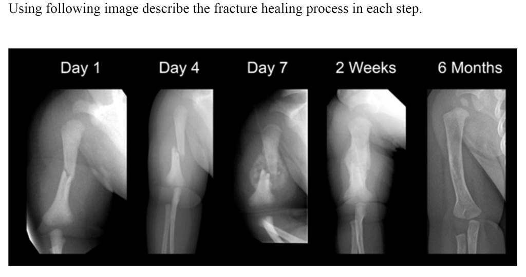 SOLVED: Using following image describe the fracture healing process in ...