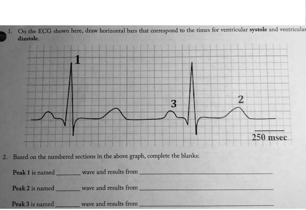 1. On the ECG shown here, draw horizontal bars that correspond to the ...