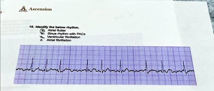 Solved 16 Identify The Below Rhythm Atrial Flutter Sinus Rhythm With