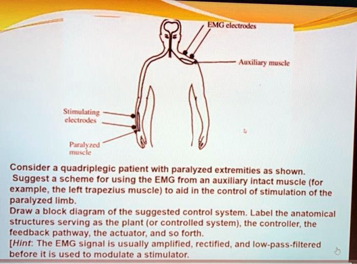 emg elextrke auxiliary muxcle stmuluing ckactmka faralyecd muck ...