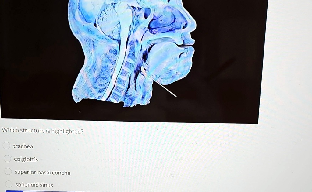 SOLVED: Which structure is highlighted? - trachea - epiglottis ...
