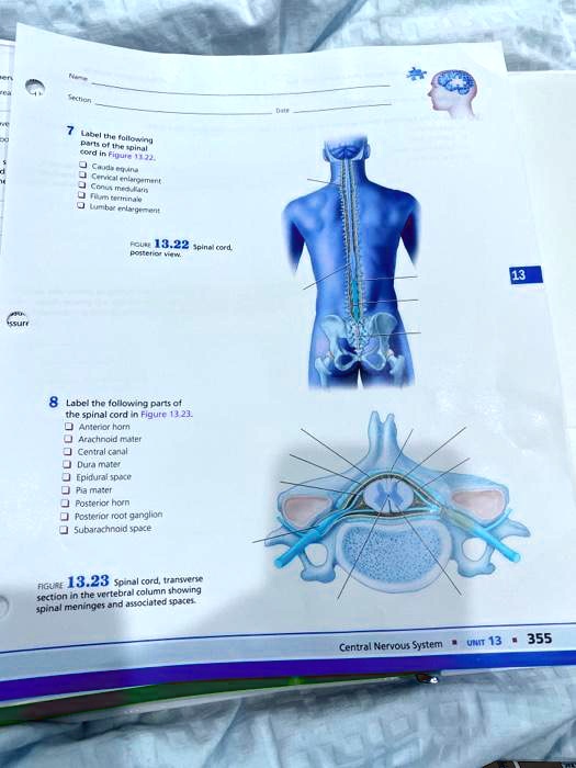 Conus Medullaris Filum Terminale Exposed Spinal Canal