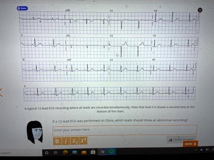SOLVED: bottom of thechart If a 12-lead ECG was performed on Olivia ...