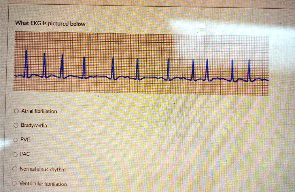 what ekg is pictured below atrial fibrillation bradycardia pvc pac ...