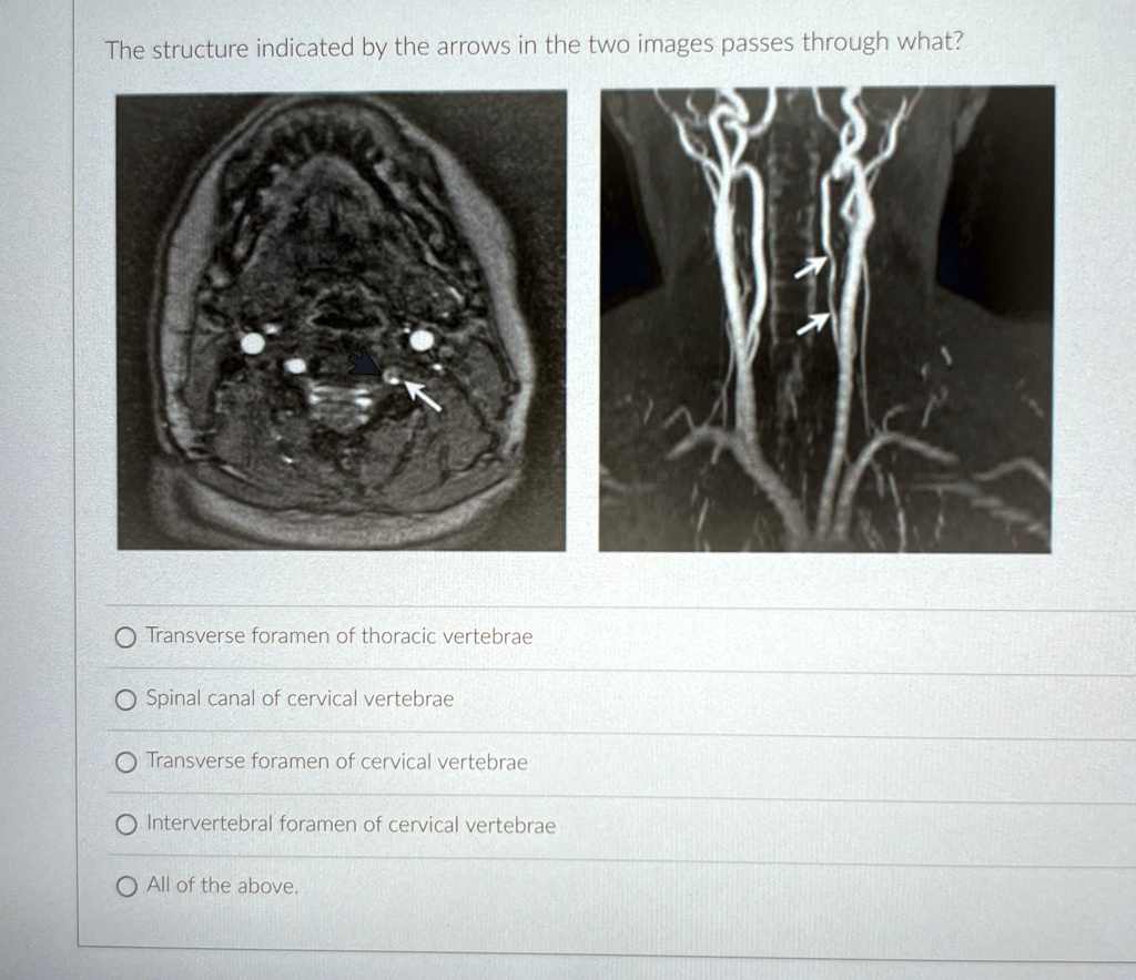 The structure indicated by the arrows in the two images passes through ...