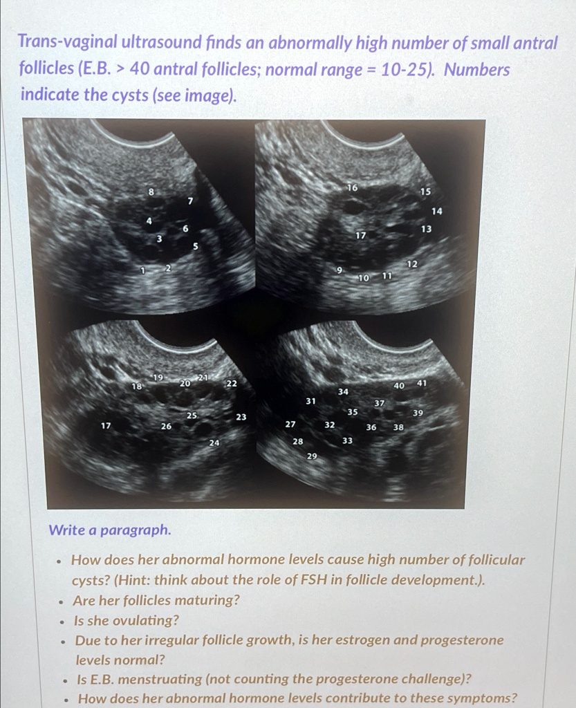 Trans-vaginal ultrasound finds an abnormally high number of small ...