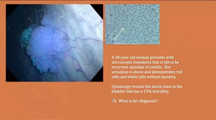A 38-year-old woman presents with microscopic hematuria that is felt to ...