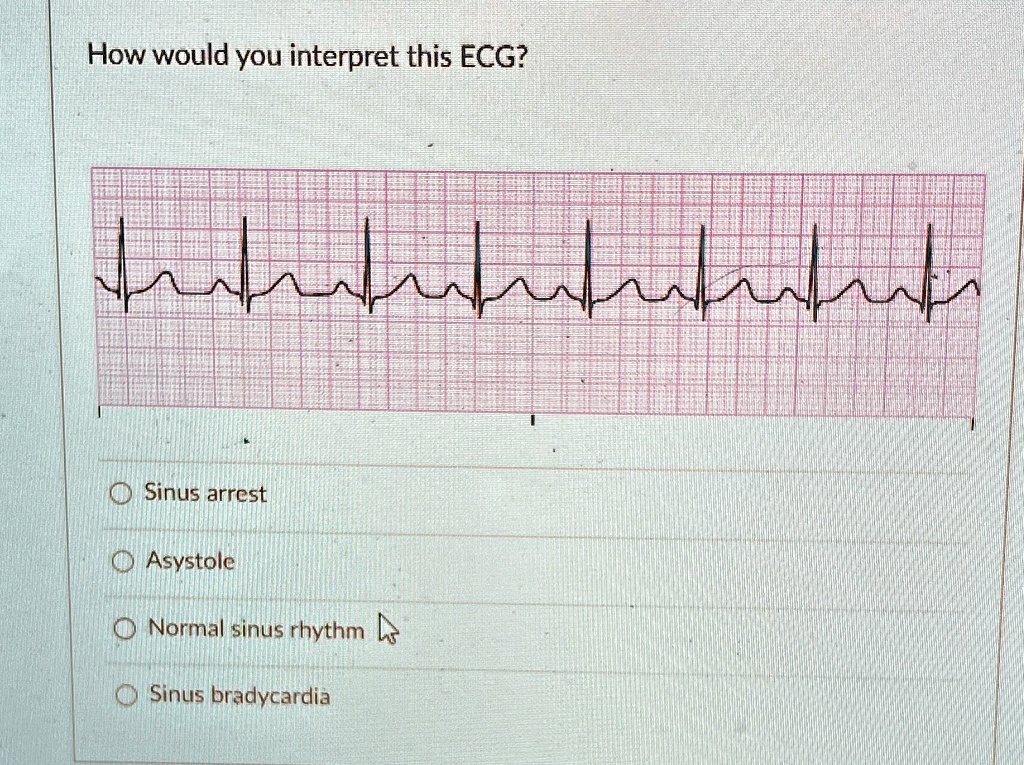 how would you interpret this ecg sinus arrest asystole normal sinus ...