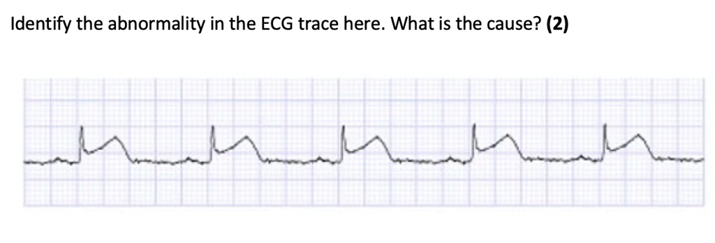Identify the abnormality in the ECG trace here. What is the...