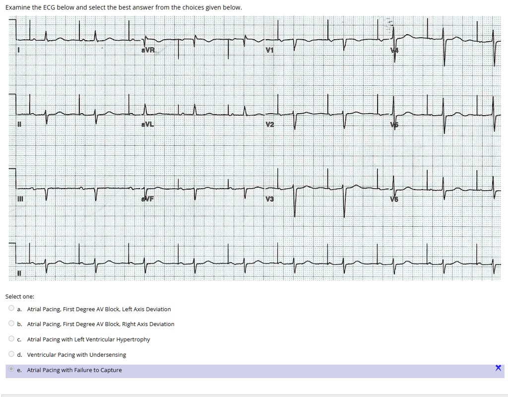 examine the ecg below and select the best answer from the choices given ...