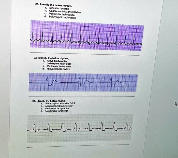 21 identify the below rhythm a sinus tachycardia b coarse ventricular fibrillation c ventricular ...