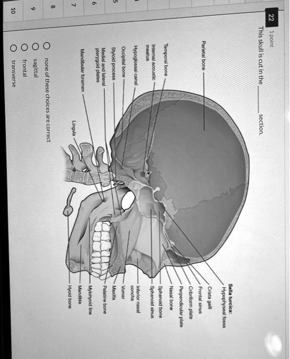 22 1 point This skull is cut in the section. Parietal bone Temporal ...