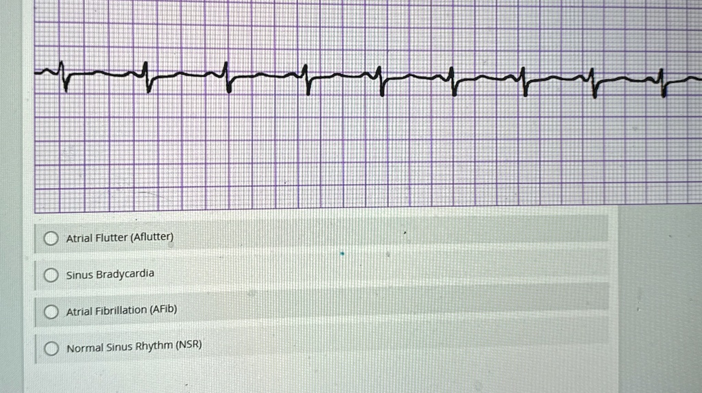 atrial flutter aflutter sinus bradycardia atrial fibrillation afib ...